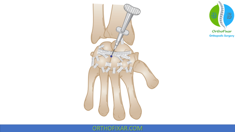 Wrist Injection Technique Easily Step-By-Step | OrthoFixar