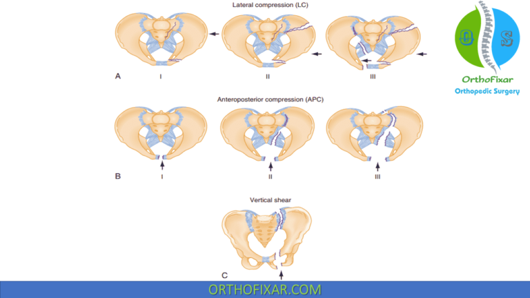 Pelvic Fractures - Easy Explained | OrthoFixar 2025