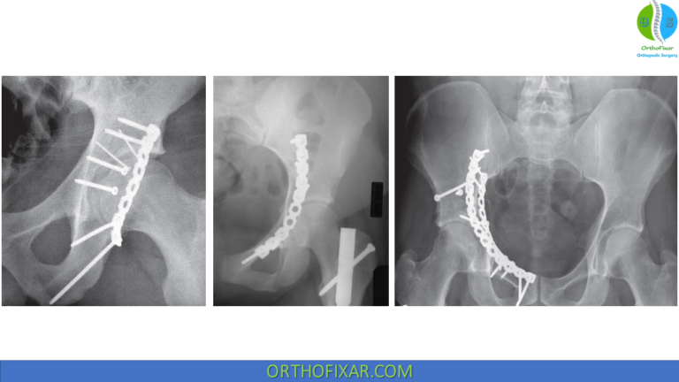 Acetabulum Fracture Full Explained | OrthoFixar 2025
