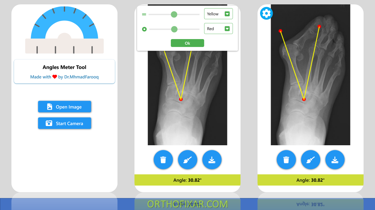 Angle Meter App For Android & IOS | OrthoFixar