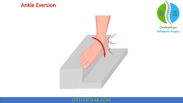 Medial Ankle Sprains | OrthoFixar