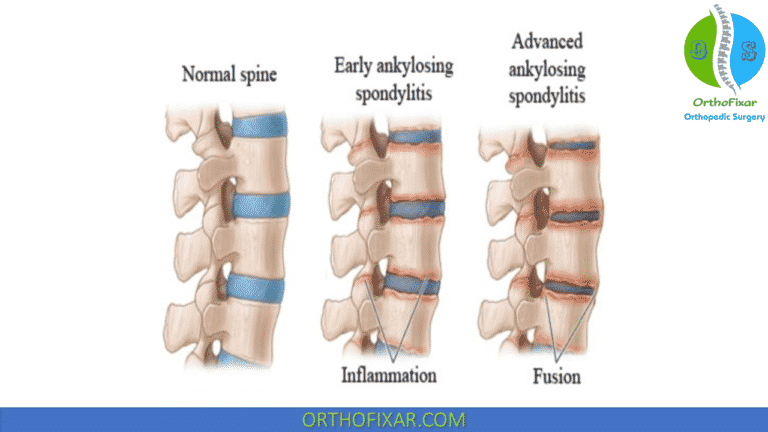 Schober Test Interpretation & Overview | OrthoFixar 2025