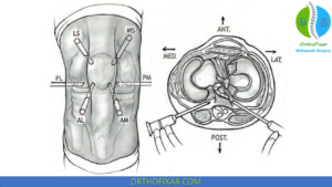 Arthroscopic Knee Synovectomy
