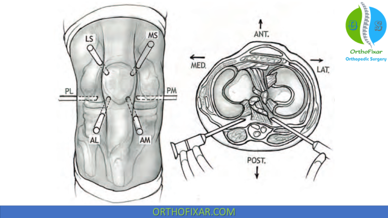 Arthroscopic Knee Synovectomy Easily Step-By-Step | OrthoFixar