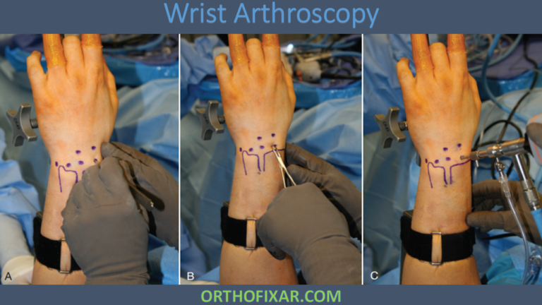 Wrist Arthroscopy • Easy Tutorial • Orthofixar 2026