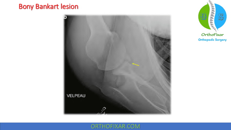 Bankart Lesion 2026 | Shoulder Dislocation