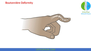 Elson Test For Central Slip Injury Explained Easily | OrthoFixar