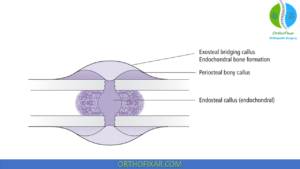 Fracture Healing - Full Tutorial | OrthoFixar 2025