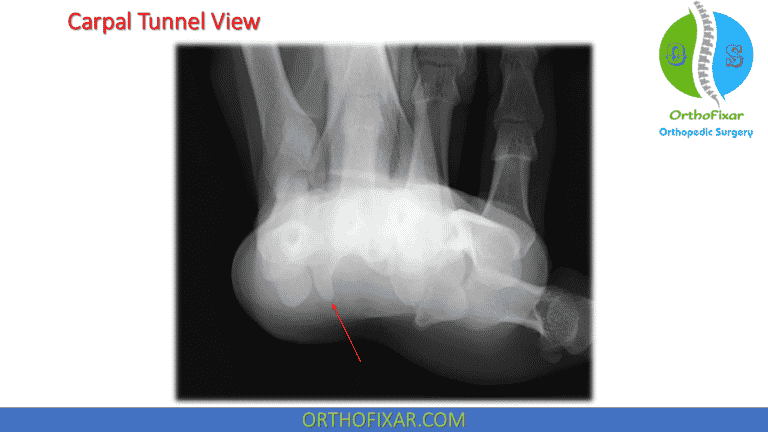 Hamate Fracture