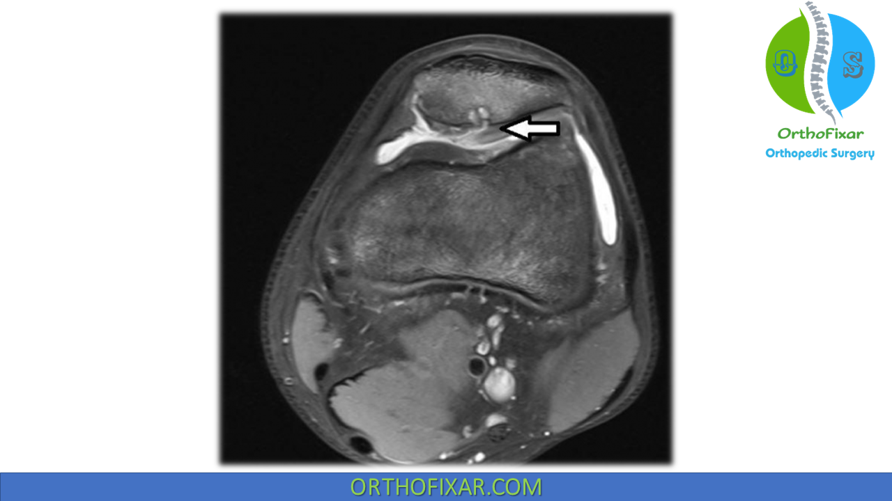 Patellar Dislocation | OrthoFixar