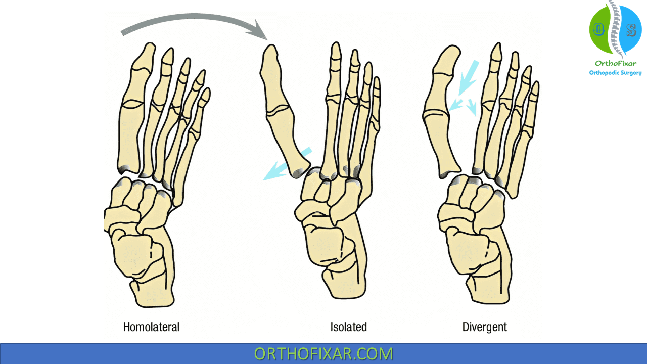 Lisfranc Fracture & Injury