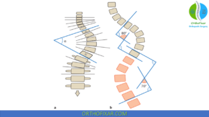 Cobb Angle For Scoliosis Explained Easily | OrthoFixar
