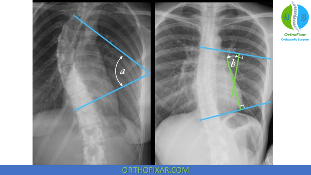 Scoliosis X Ray Cobb Angle