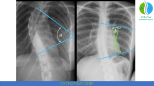 Cobb Angle For Scoliosis Explained Easily | OrthoFixar