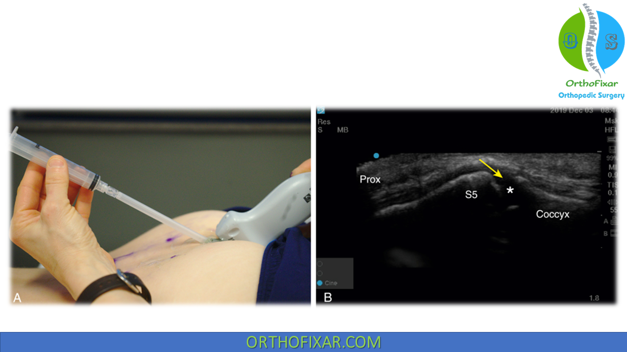 Sacrococcygeal Joint Injection Easily Step-By-Step | OrthoFixar