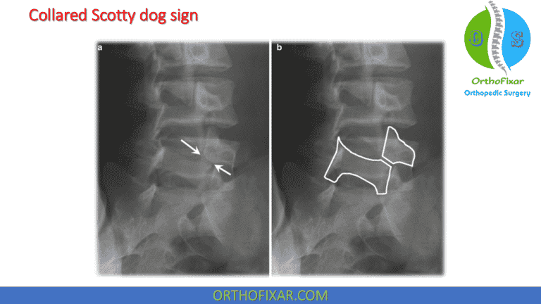 Spinal Spondylolysis