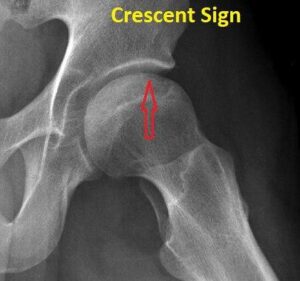 Osteonecrosis Of The Hip • Easy Explained - OrthoFixar 2022