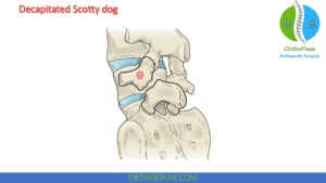 Spondylolisthesis: Causes, Symptoms & Treatment | 2026