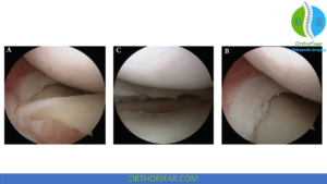 Knee Meniscus Tear Surgery Easily Step-By-Step | OrthoFixar