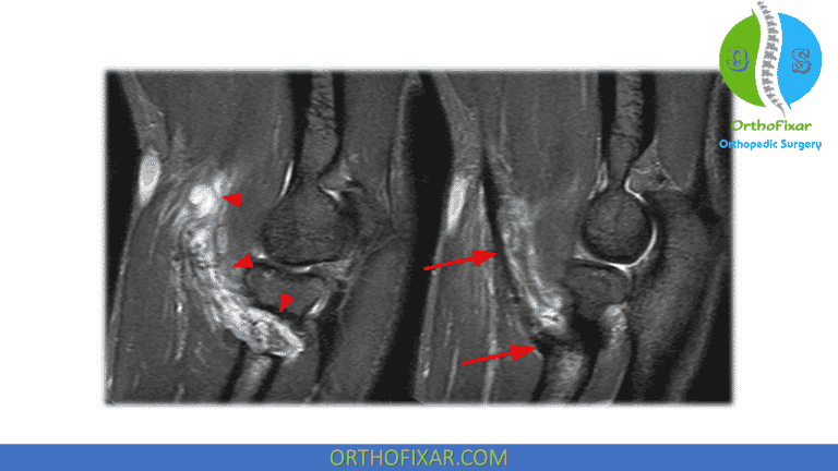 Distal Biceps Tendon Tear | OrthoFixar