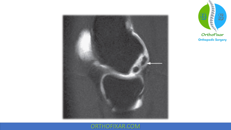 Elbow Osteochondritis Dissecans