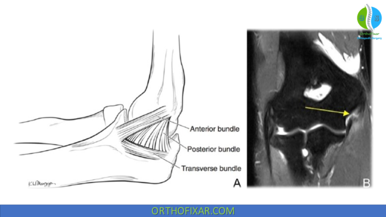 Elbow UCL Repair Surgery