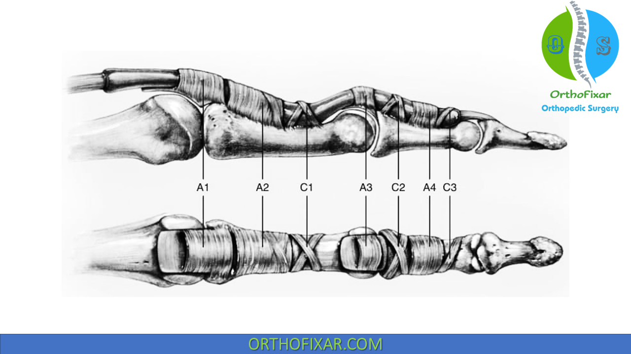 Trigger Finger | Stenosing Tenosynovitis | OrthoFixar