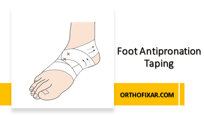 Hardinge Approach | OrthoFixar 2025