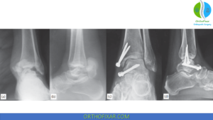 Talar Fractures & Dislocation | OrthoFixar 2025