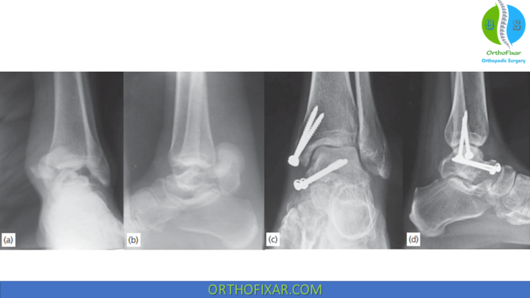 Talar Fractures & Dislocation | OrthoFixar 2025