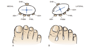 Anatomical Deformities In Hallux Valgus | Orthopedic Learning