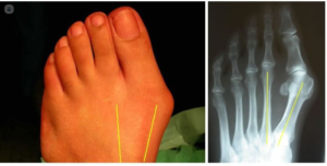 Anatomical Deformities In Hallux Valgus | OrthoFixar