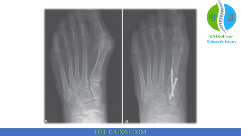 Adult Hallux Valgus - Easy Explained | OrthoFixar 2025