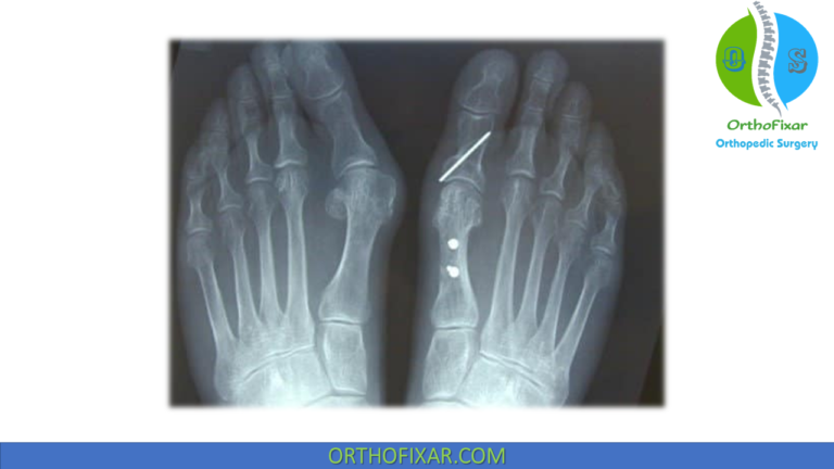 Adult Hallux Valgus - Easy Explained | OrthoFixar 2026