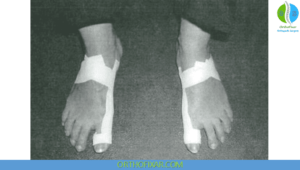 Hallux Valgus Taping Techniques | OrthoFixar 2025