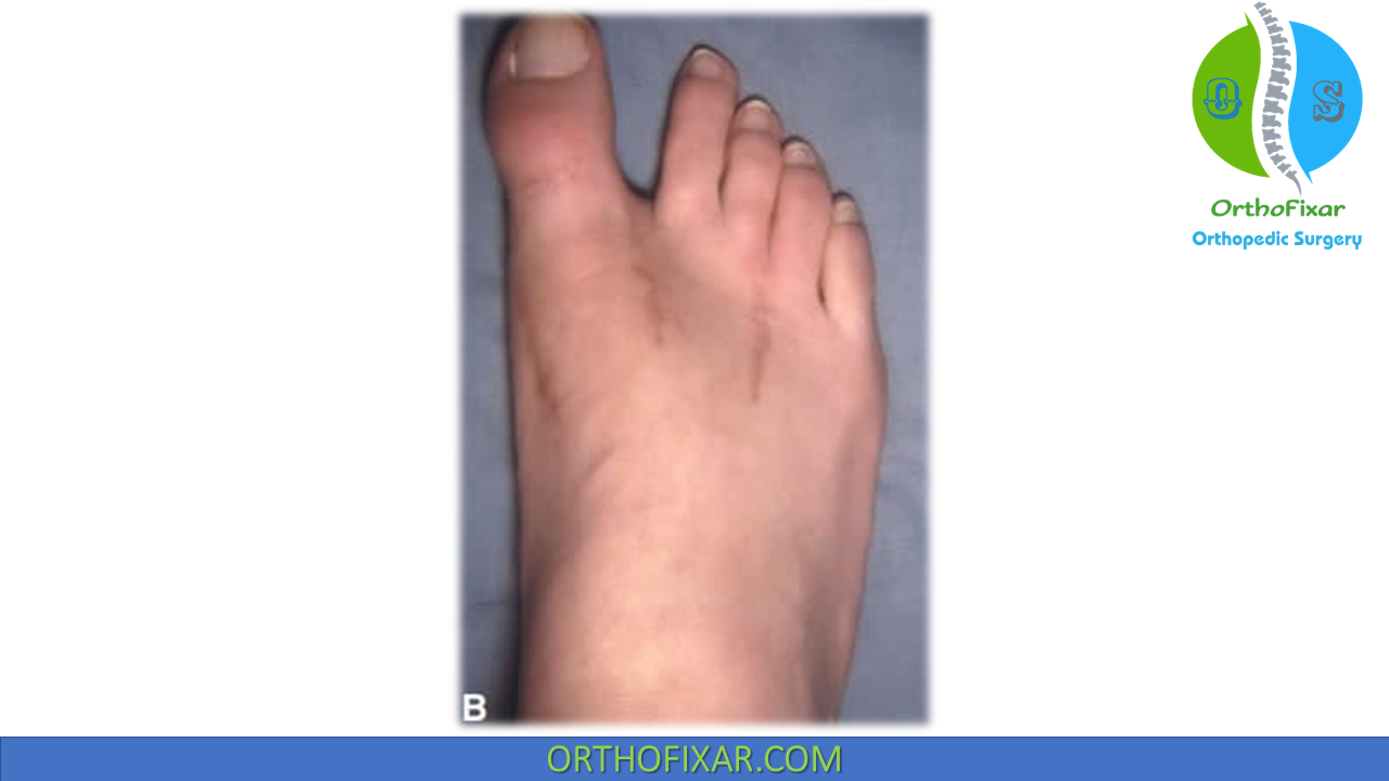Hallux Varus - Easy Explained | OrthoFixar 2025
