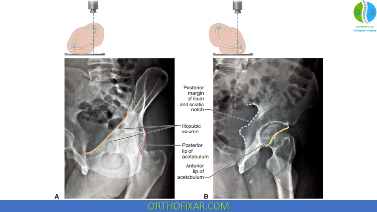 Acetabulum Fracture Full Explained | OrthoFixar 2025