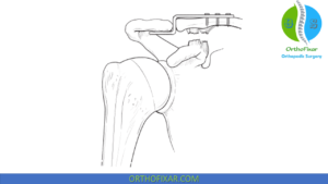 AC Joint Separation - Easy Explained | OrthoFixar 2025