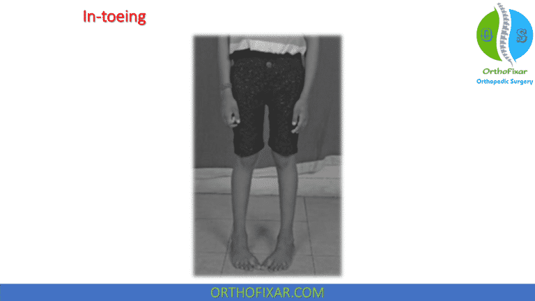 Femoral Anteversion Angle