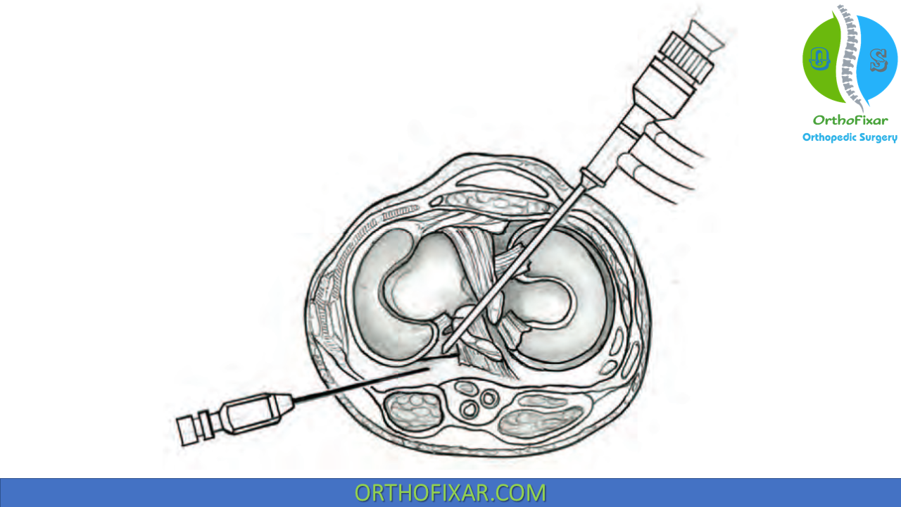 Arthroscopic Knee Synovectomy Easily Step-By-Step | OrthoFixar