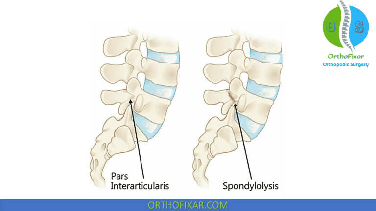 Spinal Spondylolysis | OrthoFixar