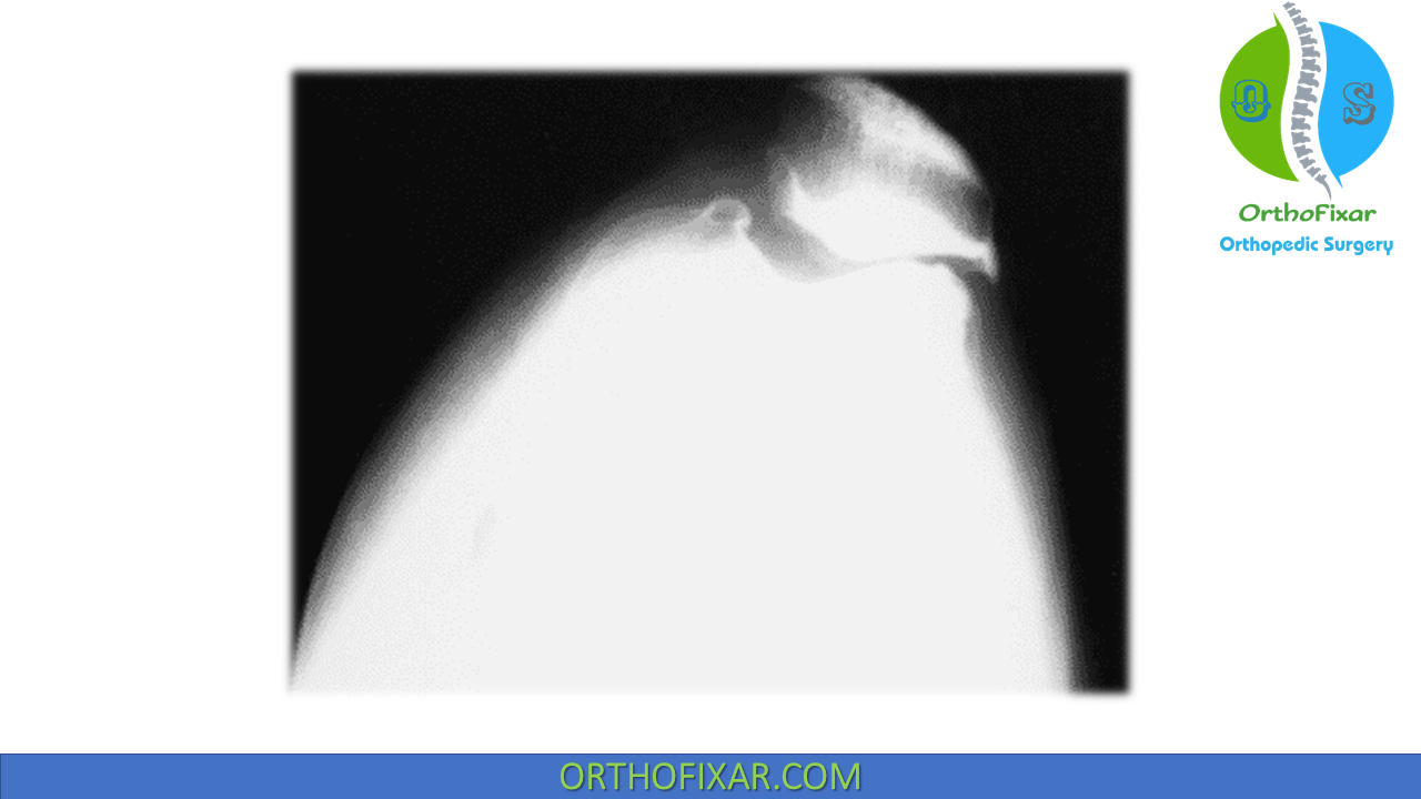 Patellar Instability - Easy Explained | OrthoFixar 2026