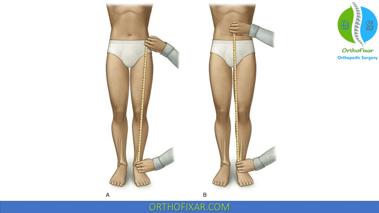 Leg Length Measurement Leg Length Measurement
