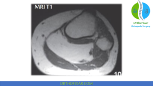 Lipoma Tumor | OrthoFixar 2026
