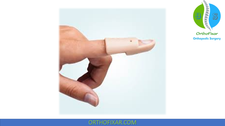 Extensor Tendon Injury Of The Hand | OrthoFixar 2025