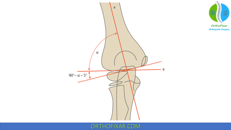 Baumann Angle For Elbow Joint Alignment Explained Easily | OrthoFixar