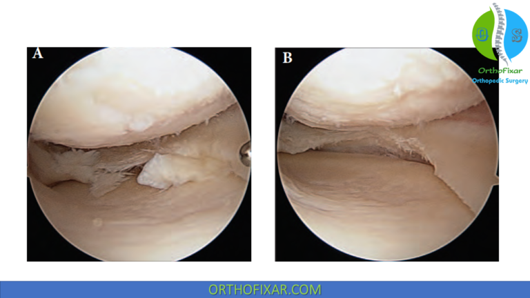 Knee Meniscus Tear Surgery | OrthoFixar 2025