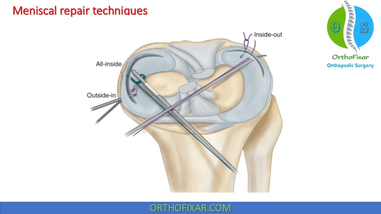 Knee Meniscus Tear Easy Explained OrthoFixar 2023 58 OFF