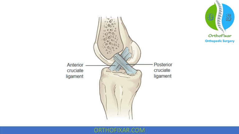 Knee PCL Injury | OrthoFixar