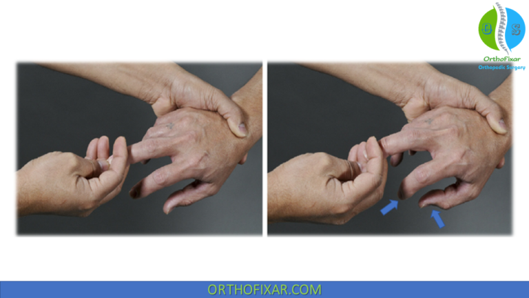 Hoffman Sign For Upper Motor Neuron Explained Easily | OrthoFixar